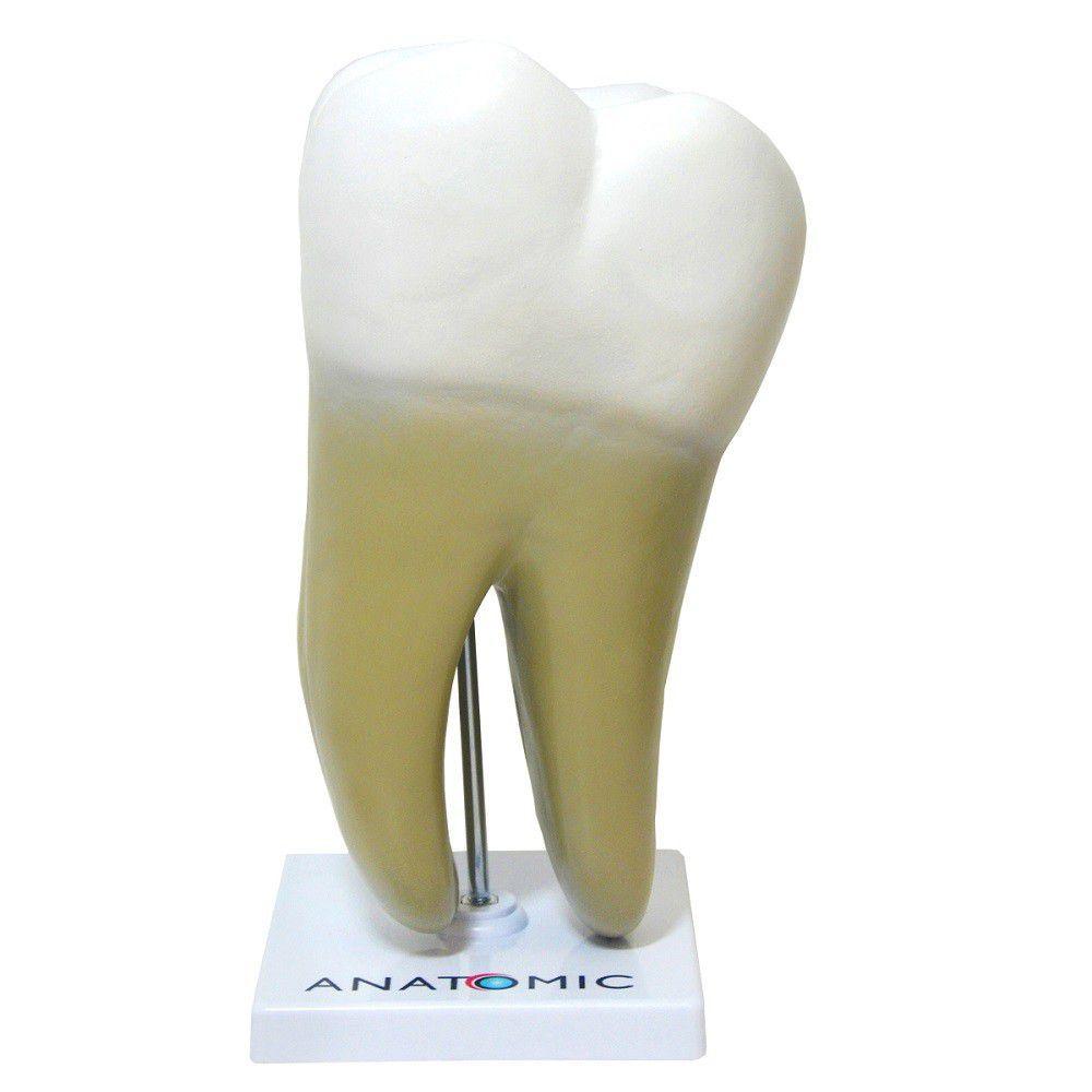Dente Molar Ampliado Saudável E Cárie Modelo Anatomia Modelo Composto