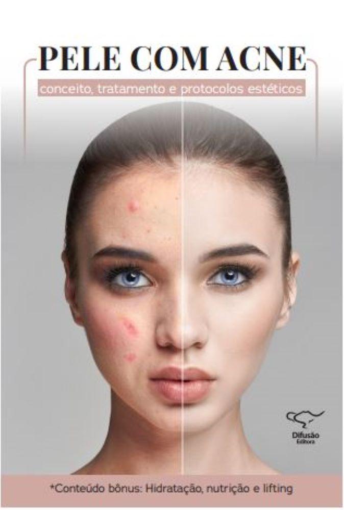 Pele Com Acne: Conceito, Tratamento E Protocolos Estéticos - Conceito ...